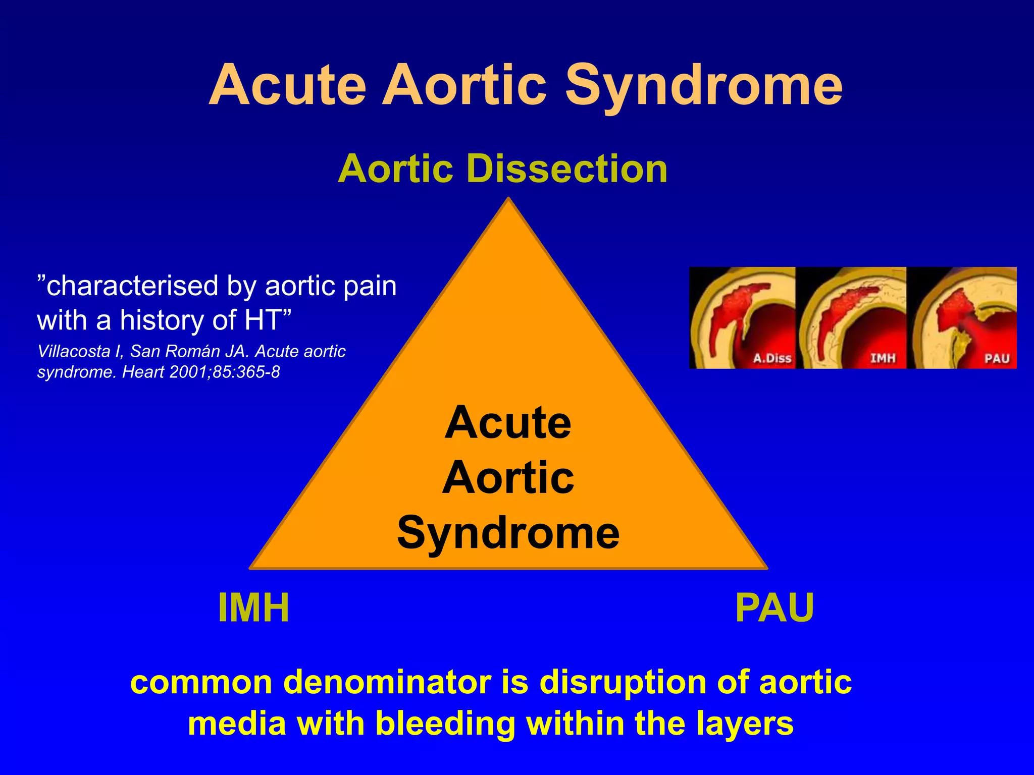 Final acute aortic syndrome = dr sanjiv | PPTX