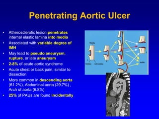 Final acute aortic syndrome = dr sanjiv | PPTX