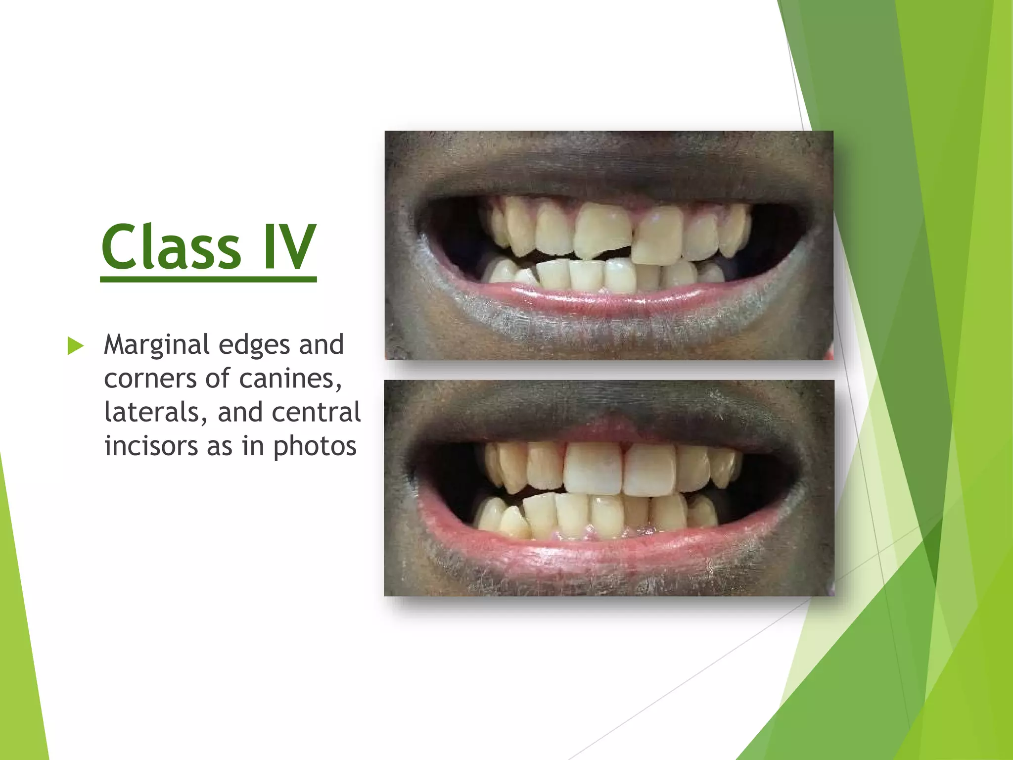 Aesthetic Anterior Composite - A Simple Technique | PDF
