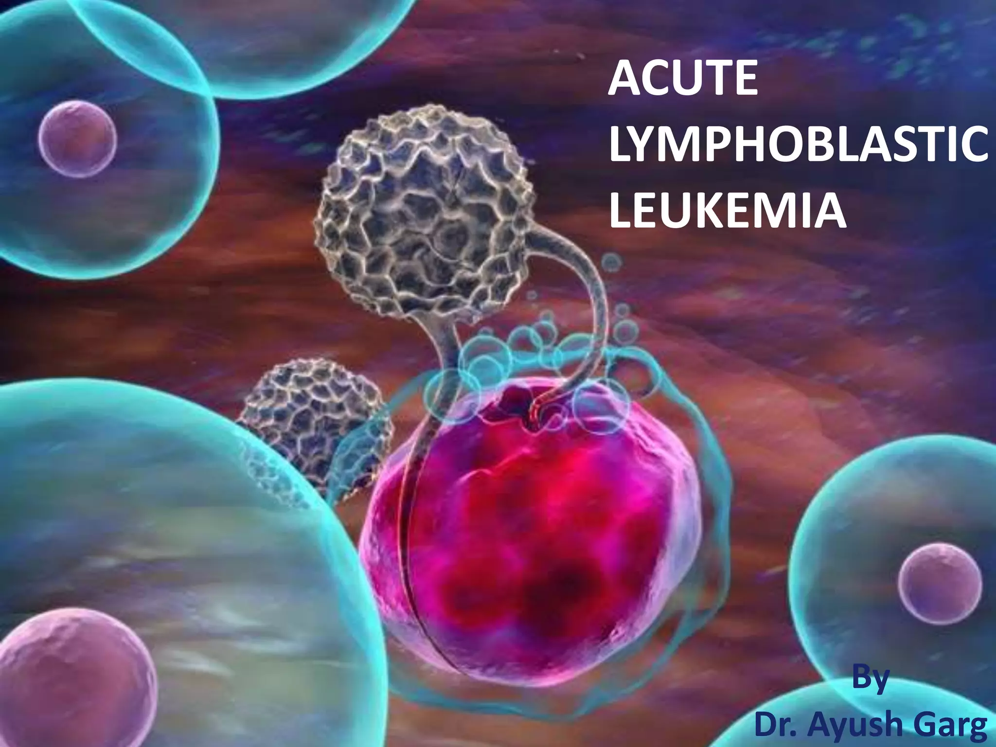 Acute Lymphoblastic Leukemia | PPTX