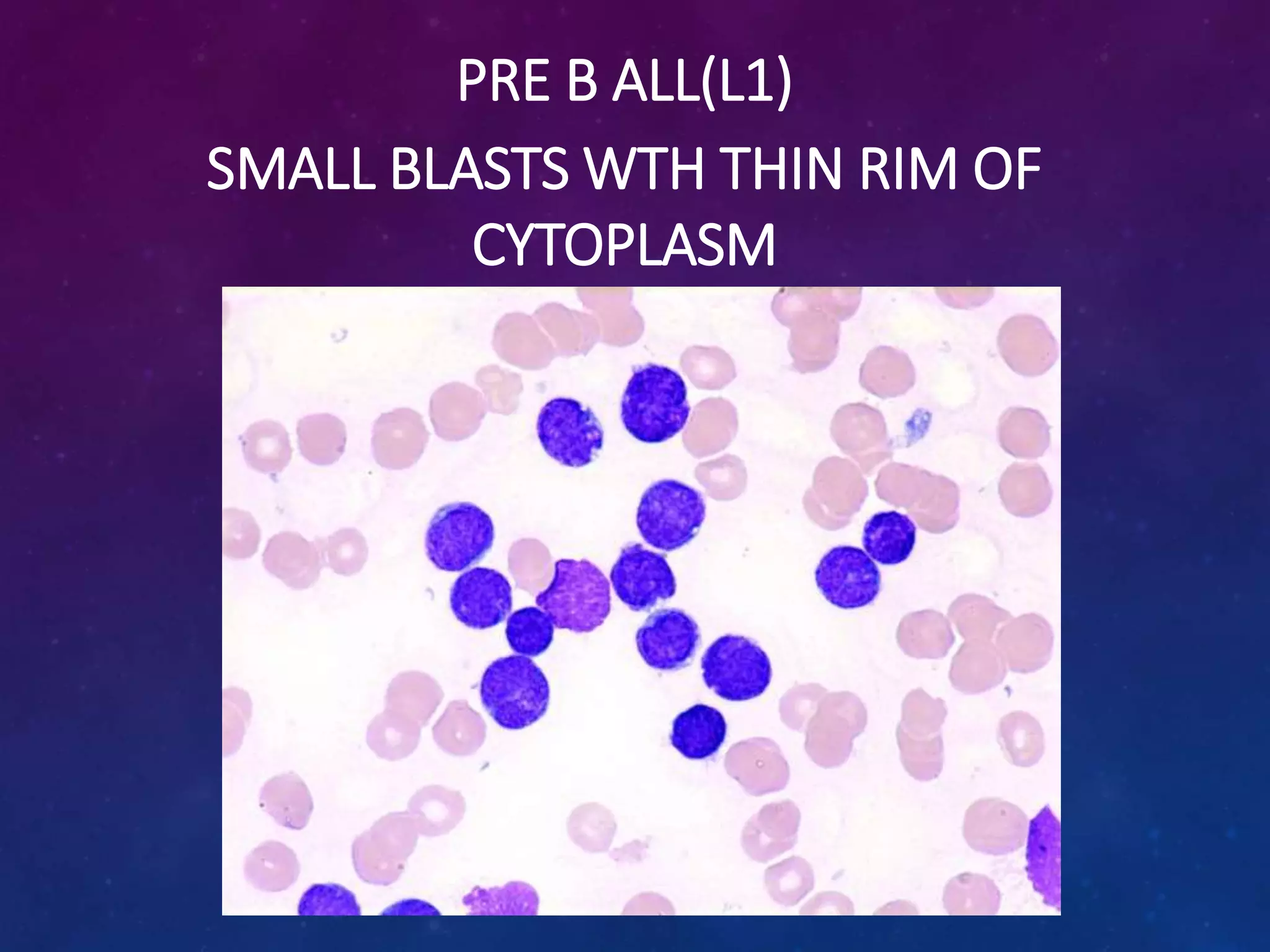 Acute Lymphoblastic Leukemia | PPTX