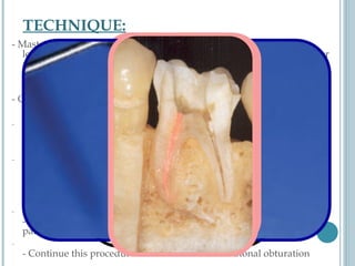 Endodontic treatment systems presentation by Afnan Nassar | PPT