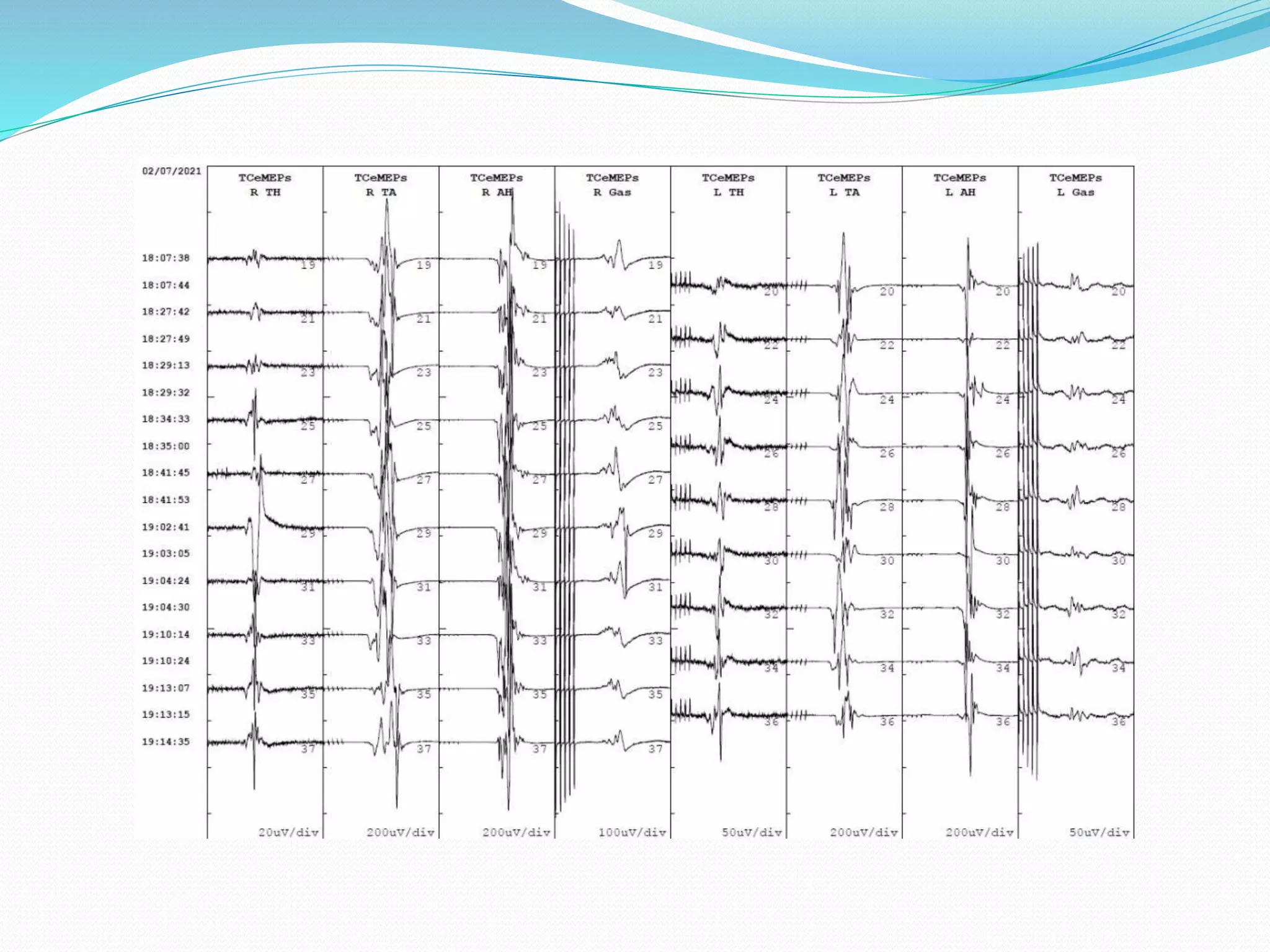 Multimodality IONM in spine surgery | PPTX