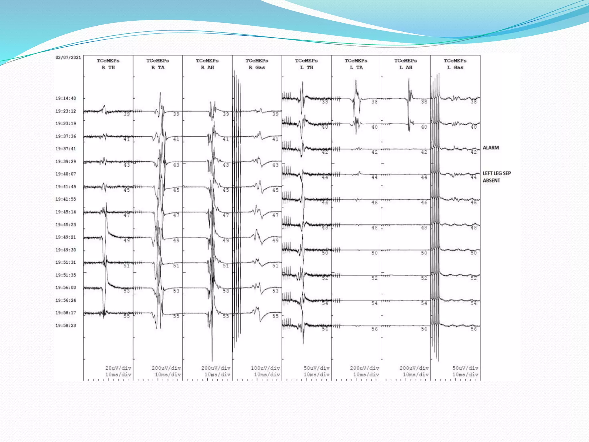 Multimodality IONM in spine surgery | PPTX
