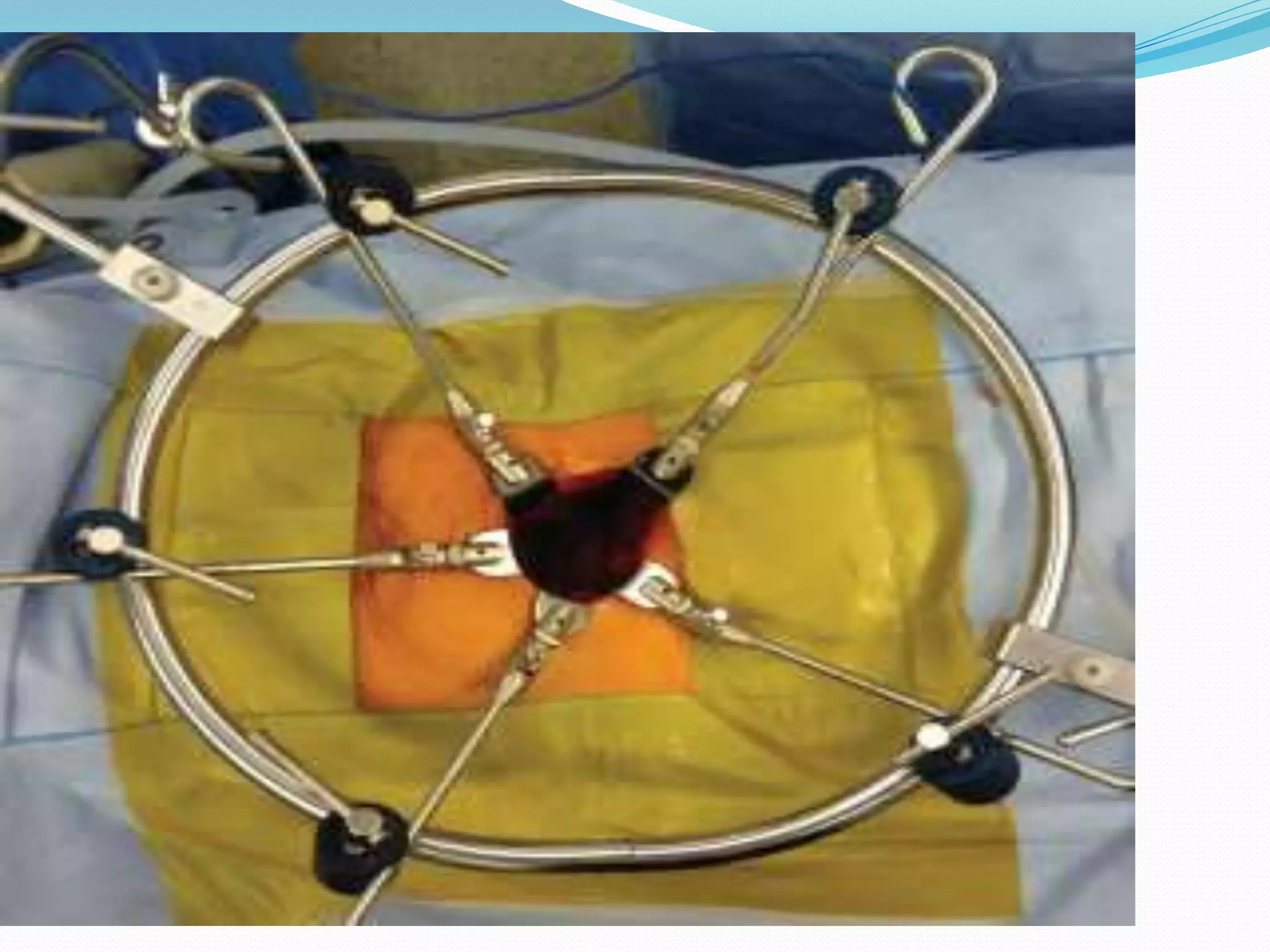 Multimodality IONM in spine surgery | PPTX