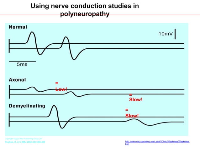 approach to polyneuropathy | PPTX