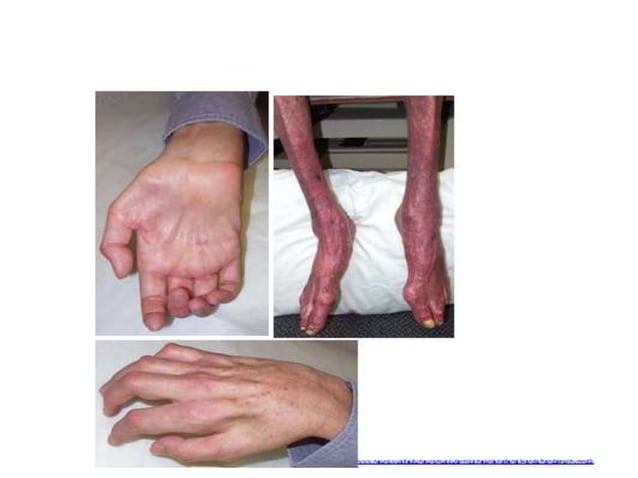 approach to polyneuropathy | PPTX