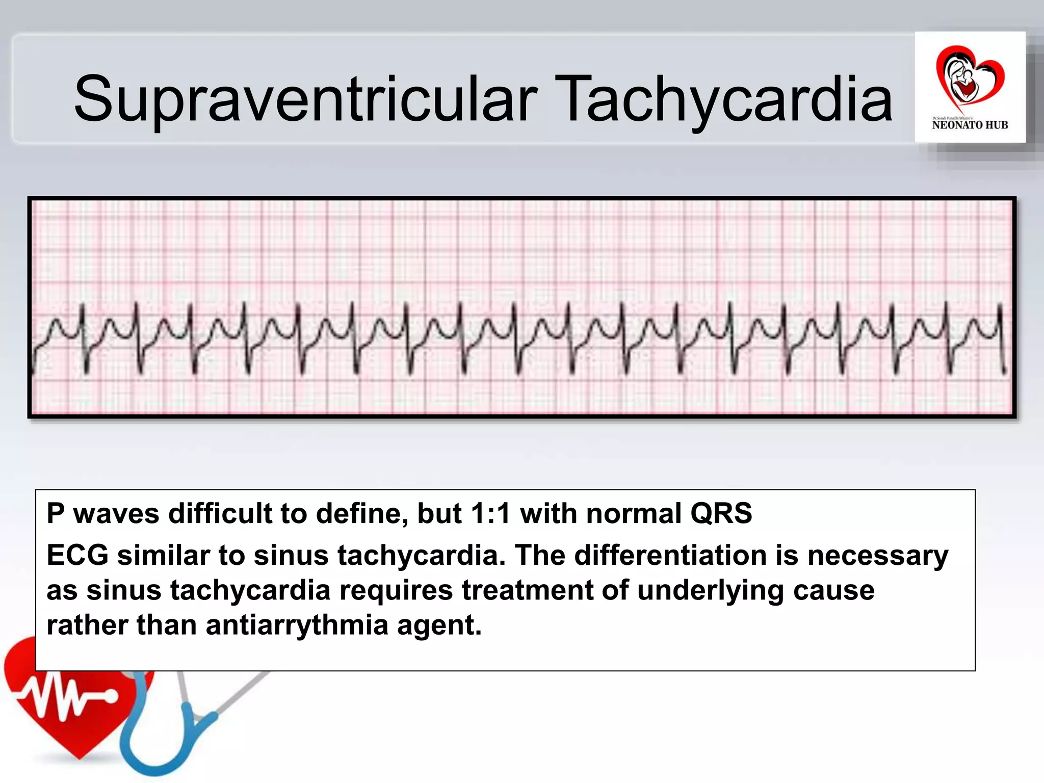 Pediatric Arrythmias | PPT