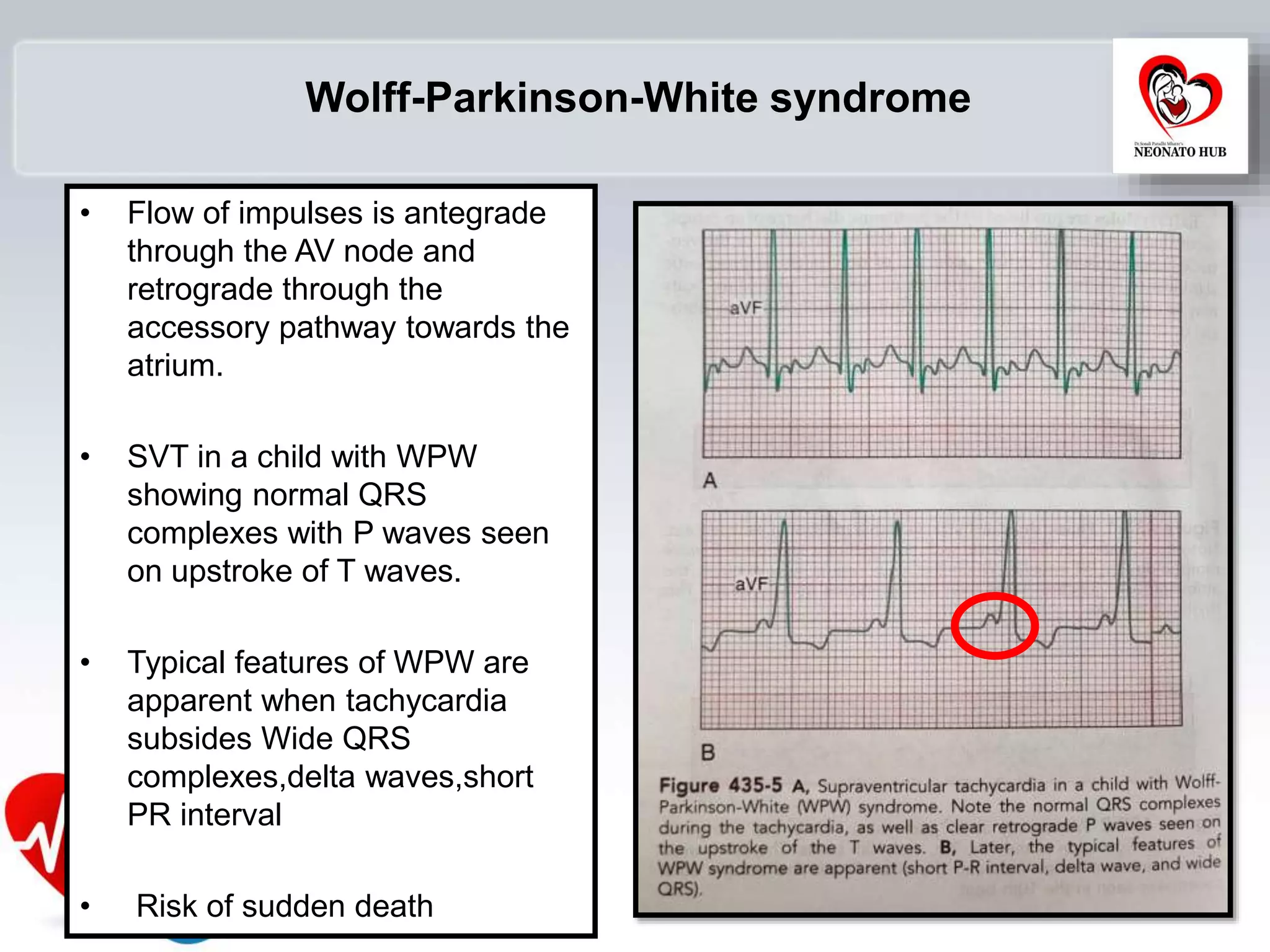 Pediatric Arrythmias | PPT