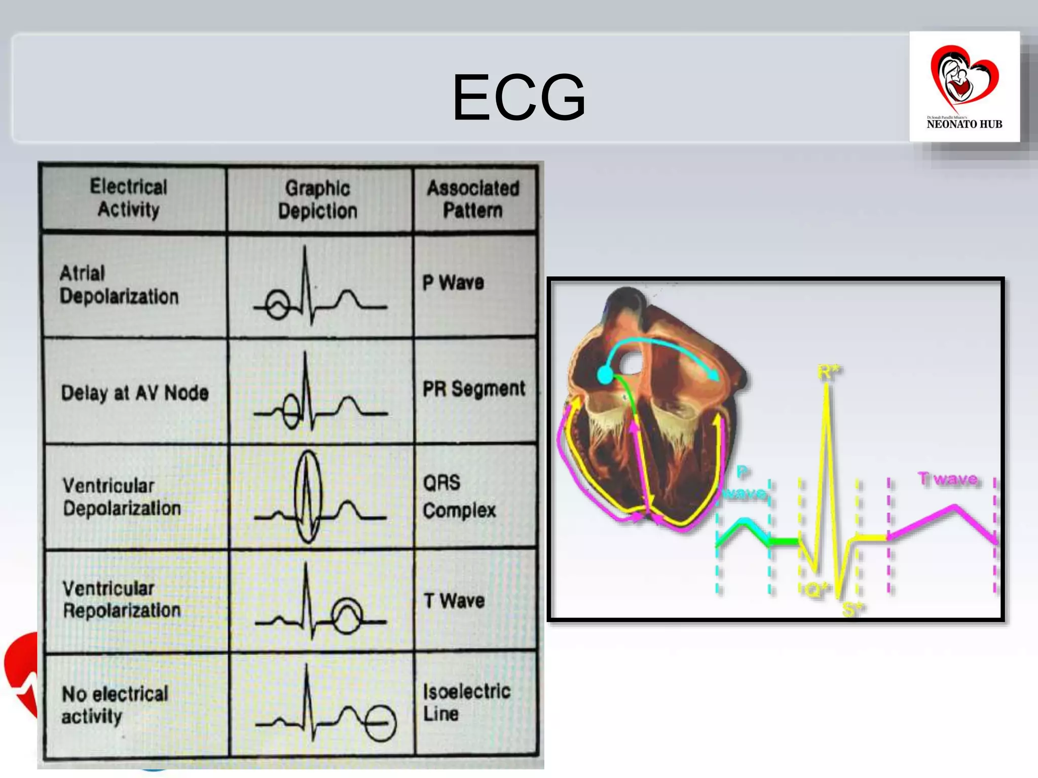 Pediatric Arrythmias | PPT