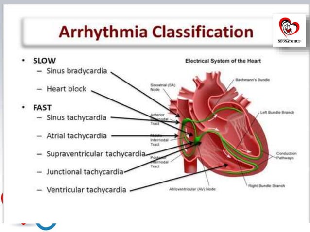 Pediatric Arrythmias | PPT | Heart and Cardiovascular Diseases ...