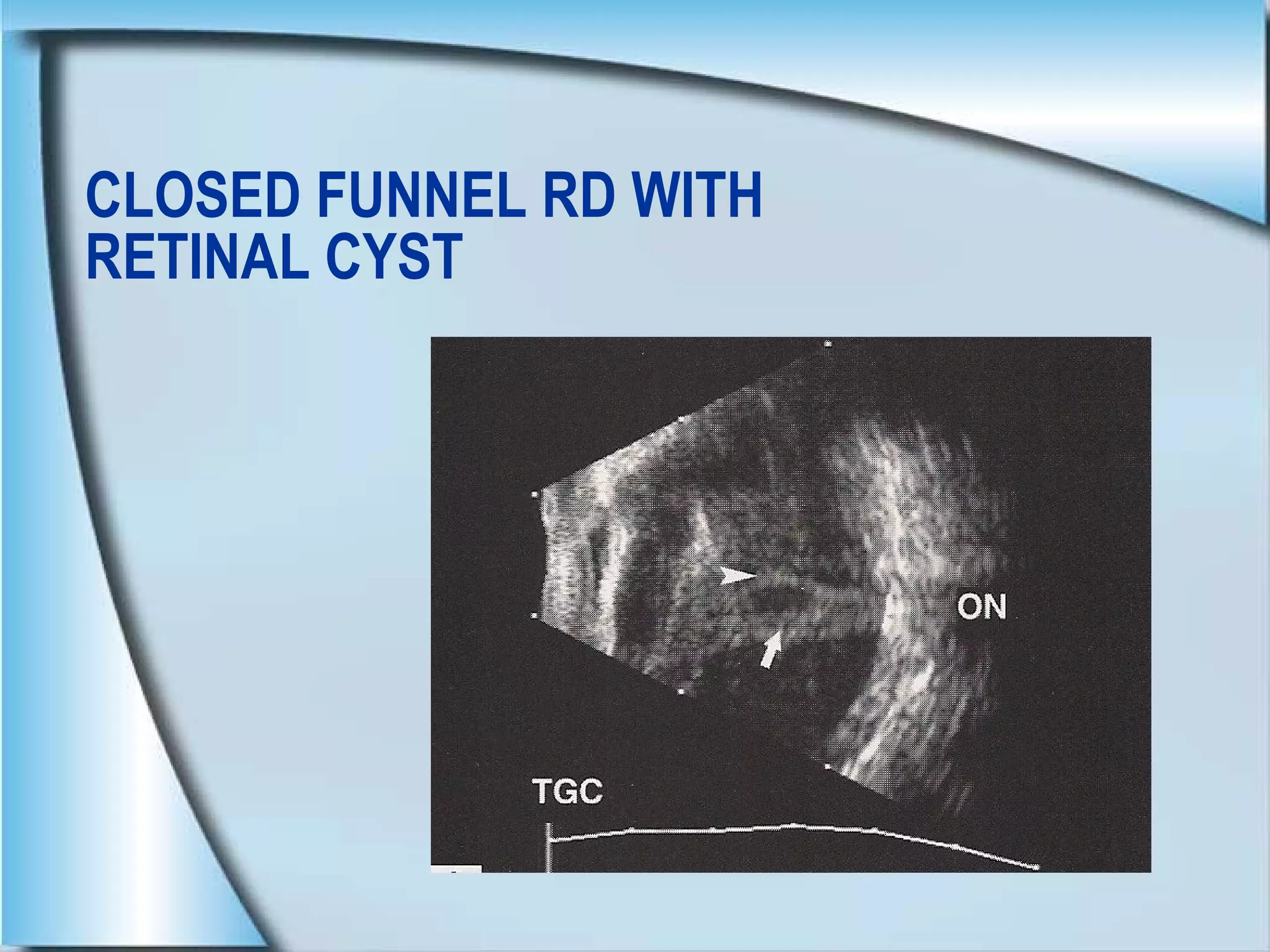 B SCAN | PPT | Eye and Vision Conditions | Diseases and Conditions