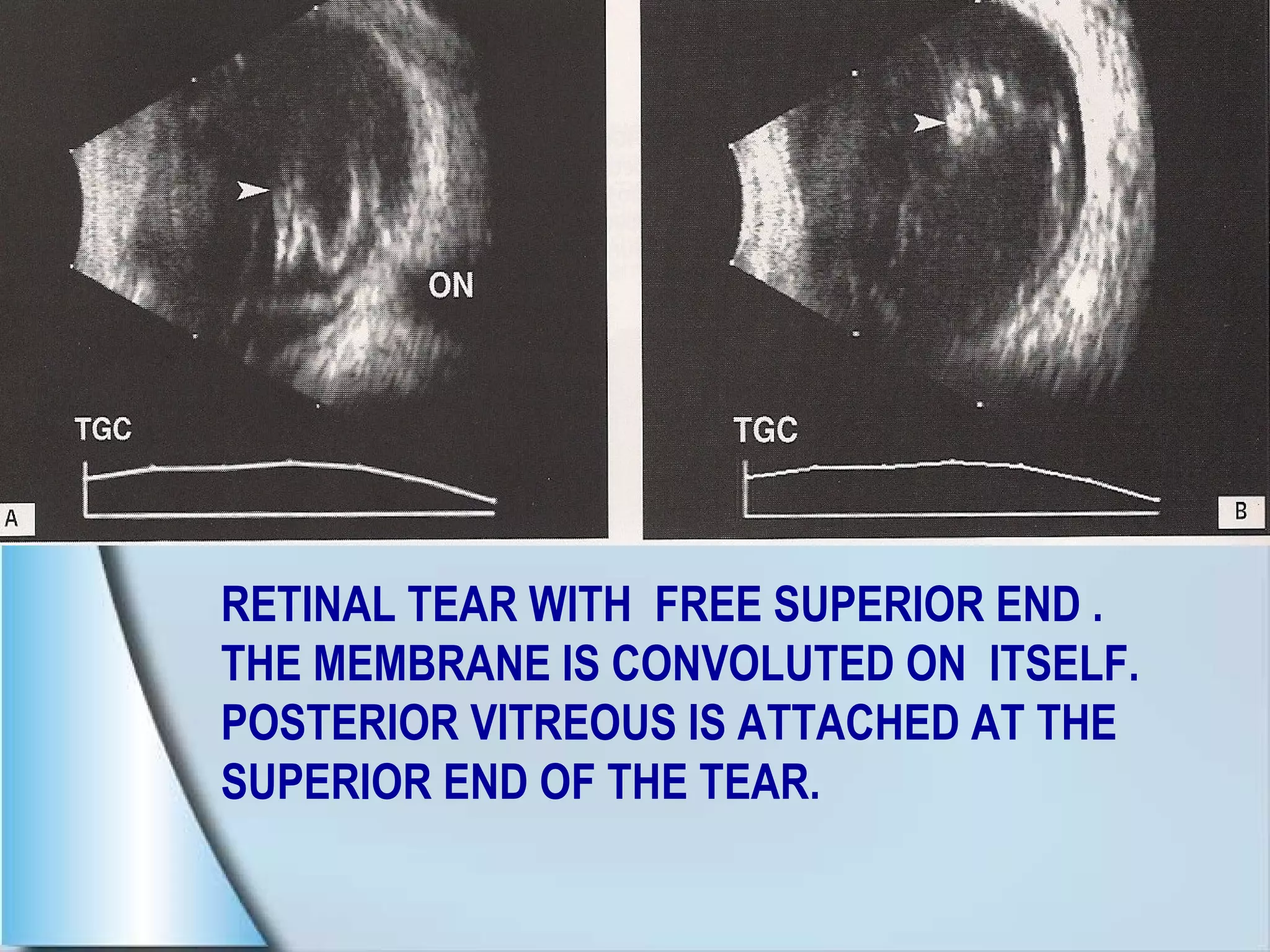 B SCAN | PPT | Eye and Vision Conditions | Diseases and Conditions