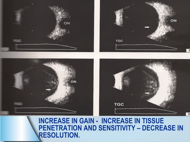 B SCAN | PPT | Eye and Vision Conditions | Diseases and Conditions