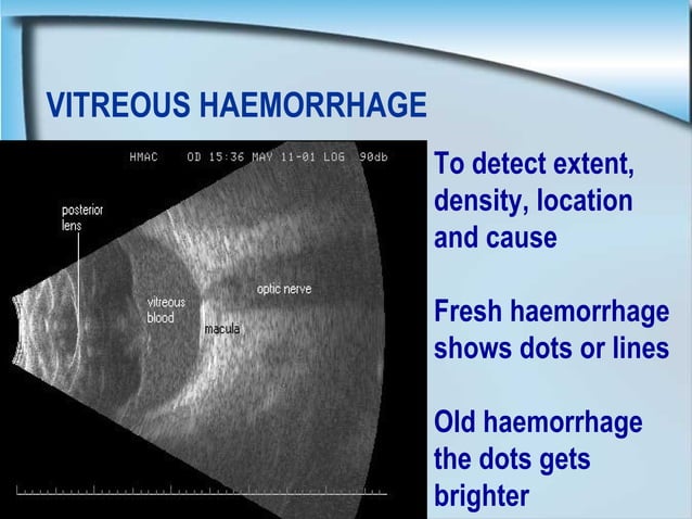 B SCAN | PPT | Eye and Vision Conditions | Diseases and Conditions