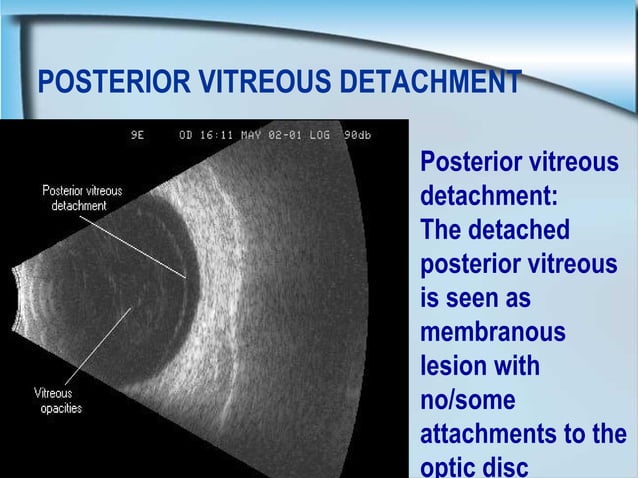 B SCAN | PPT | Eye and Vision Conditions | Diseases and Conditions
