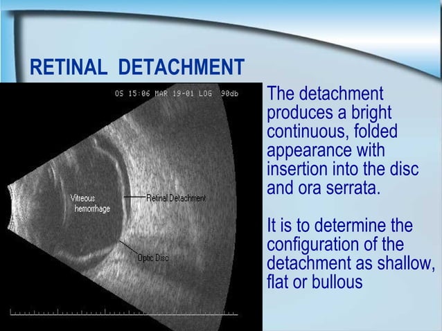 B SCAN | PPT | Eye and Vision Conditions | Diseases and Conditions