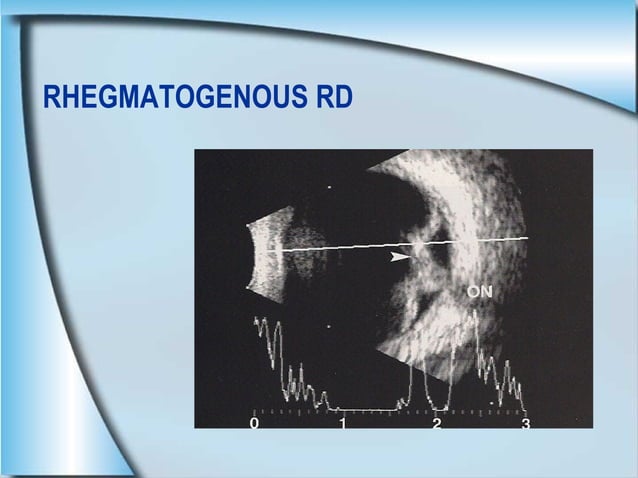 B SCAN | PPT | Eye and Vision Conditions | Diseases and Conditions
