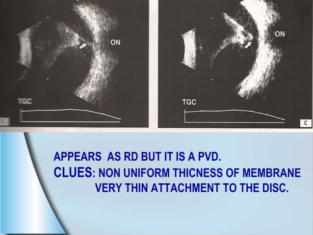 B SCAN | PPT | Eye and Vision Conditions | Diseases and Conditions