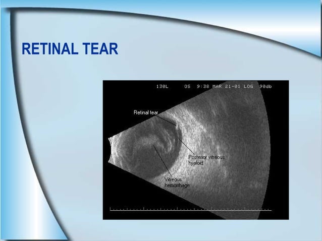B SCAN | PPT | Eye and Vision Conditions | Diseases and Conditions