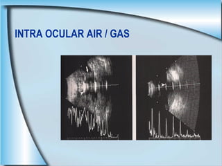 B SCAN | PPT