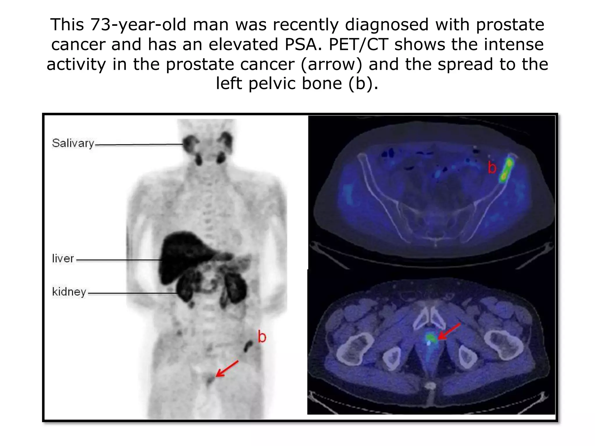 CA Prostate | PPTX | Cancer | Diseases and Conditions