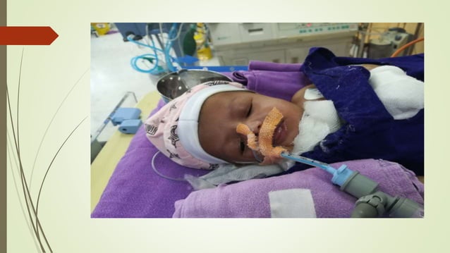 care of child on ventilator | PPTX | Lung and Respiratory Health ...