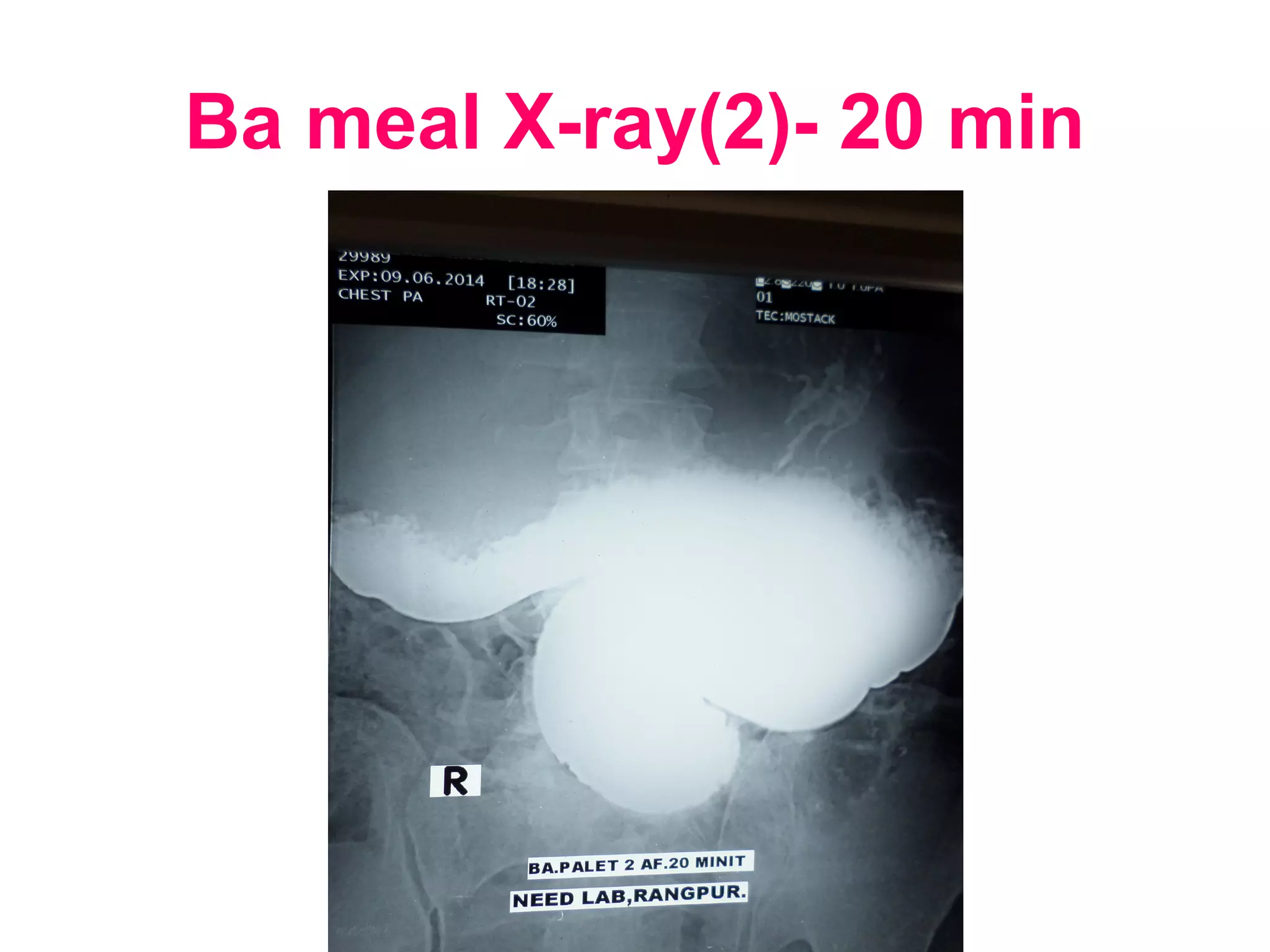 Post Operative (Gastro-Jejunostomy) Efferent Loop Obstruction due to ...