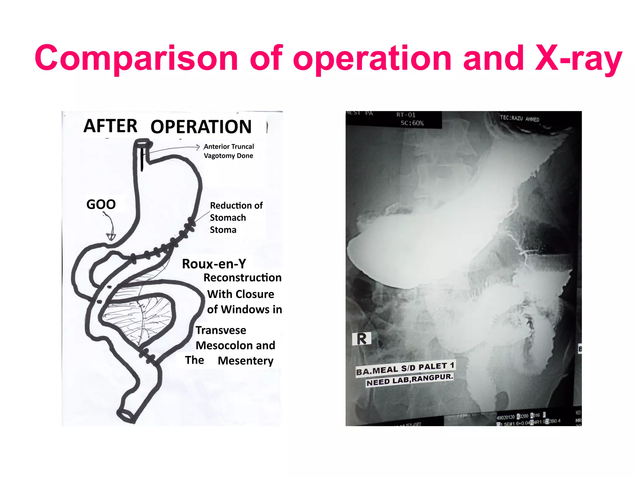 Post Operative (Gastro-Jejunostomy) Efferent Loop Obstruction due to ...