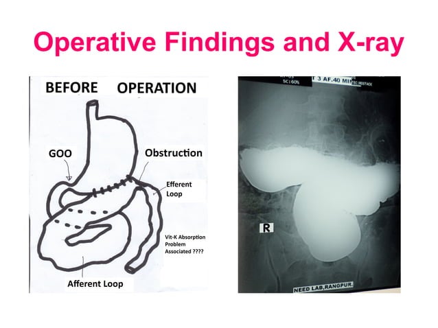 Post Operative (Gastro-Jejunostomy) Efferent Loop Obstruction due to ...