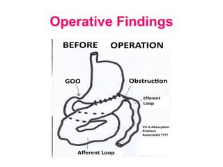 Post Operative (Gastro-Jejunostomy) Efferent Loop Obstruction due to ...