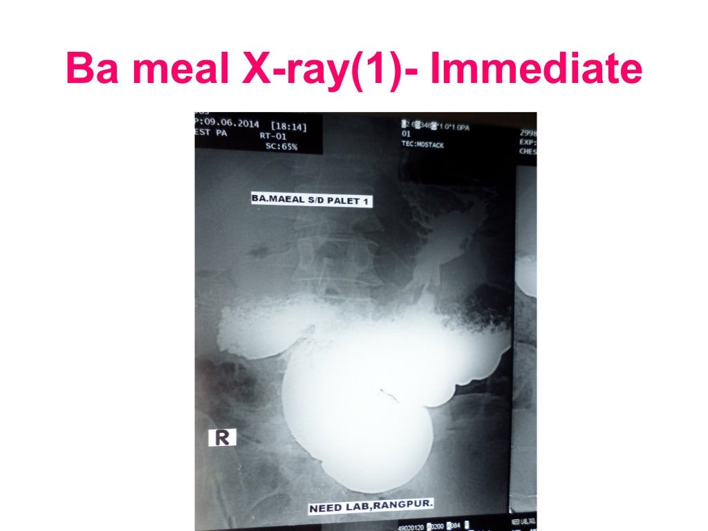 Post Operative Gastro Jejunostomy Efferent Loop Obstruction Due To