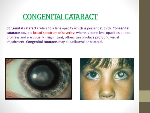 Cataract.pptx