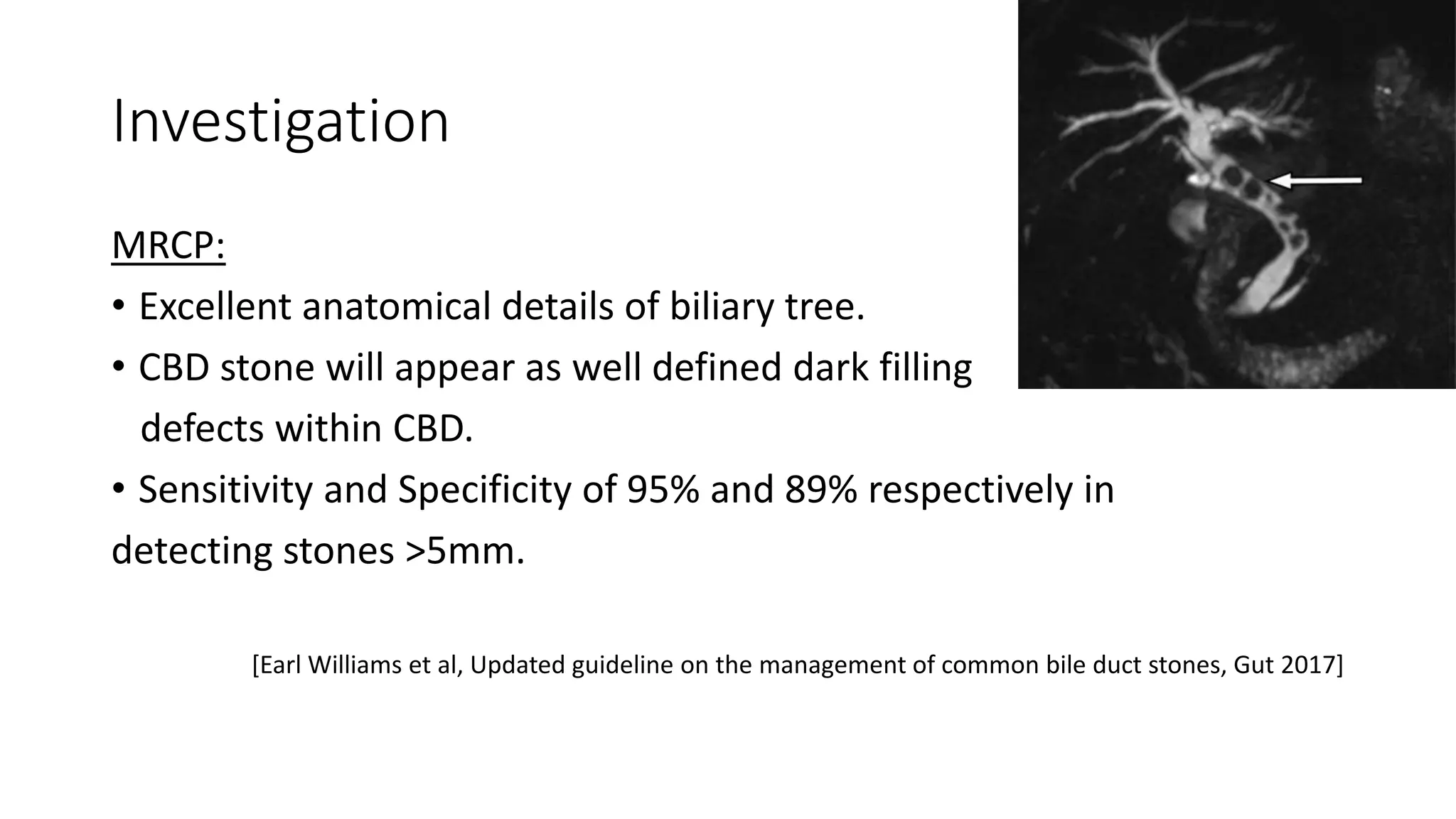 Choledocholithiasis- Management | PPTX
