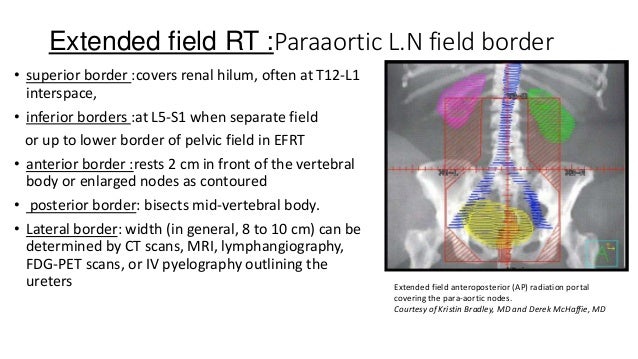 EBRT IN CARCINOMA CERVIX