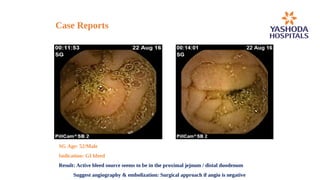 Capsule Endoscopy & Motorized Spiral Enteroscopy for Small Bowel ...
