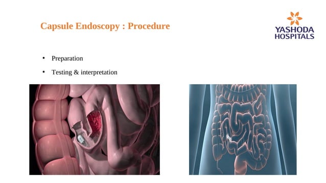Capsule Endoscopy & Motorized Spiral Enteroscopy for Small Bowel ...
