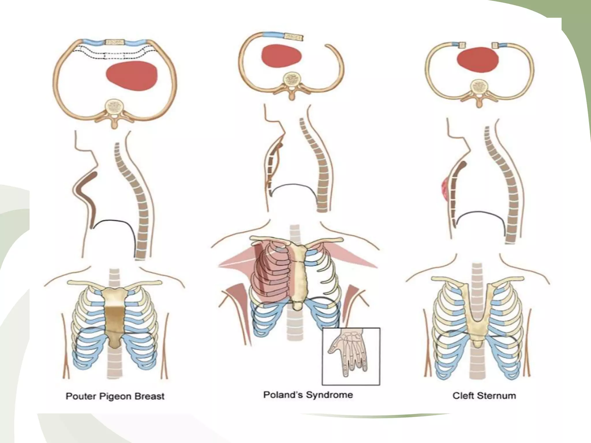 Congenital Chest Wall Abnormality | PPTX
