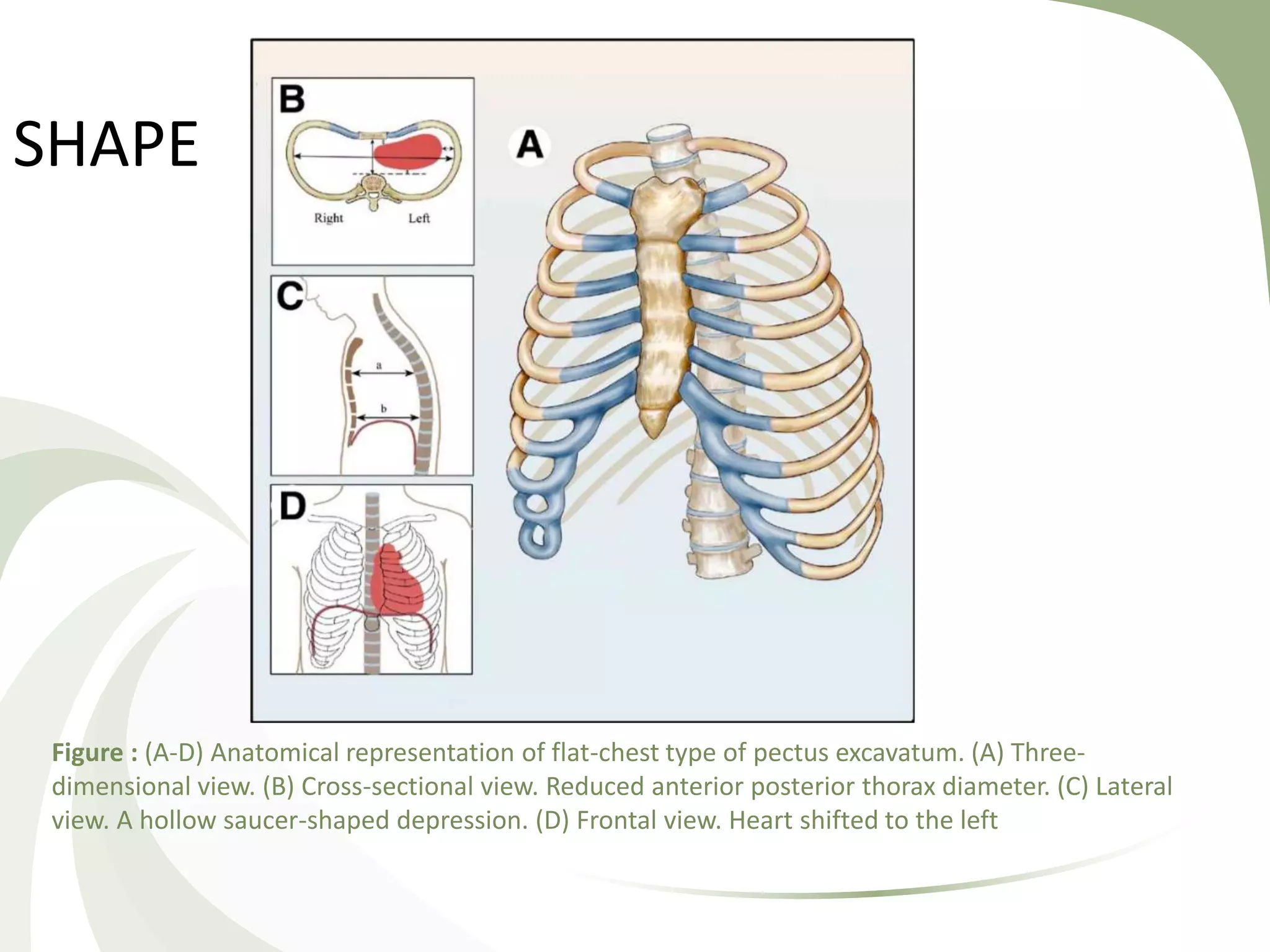 Congenital Chest Wall Abnormality | PPTX
