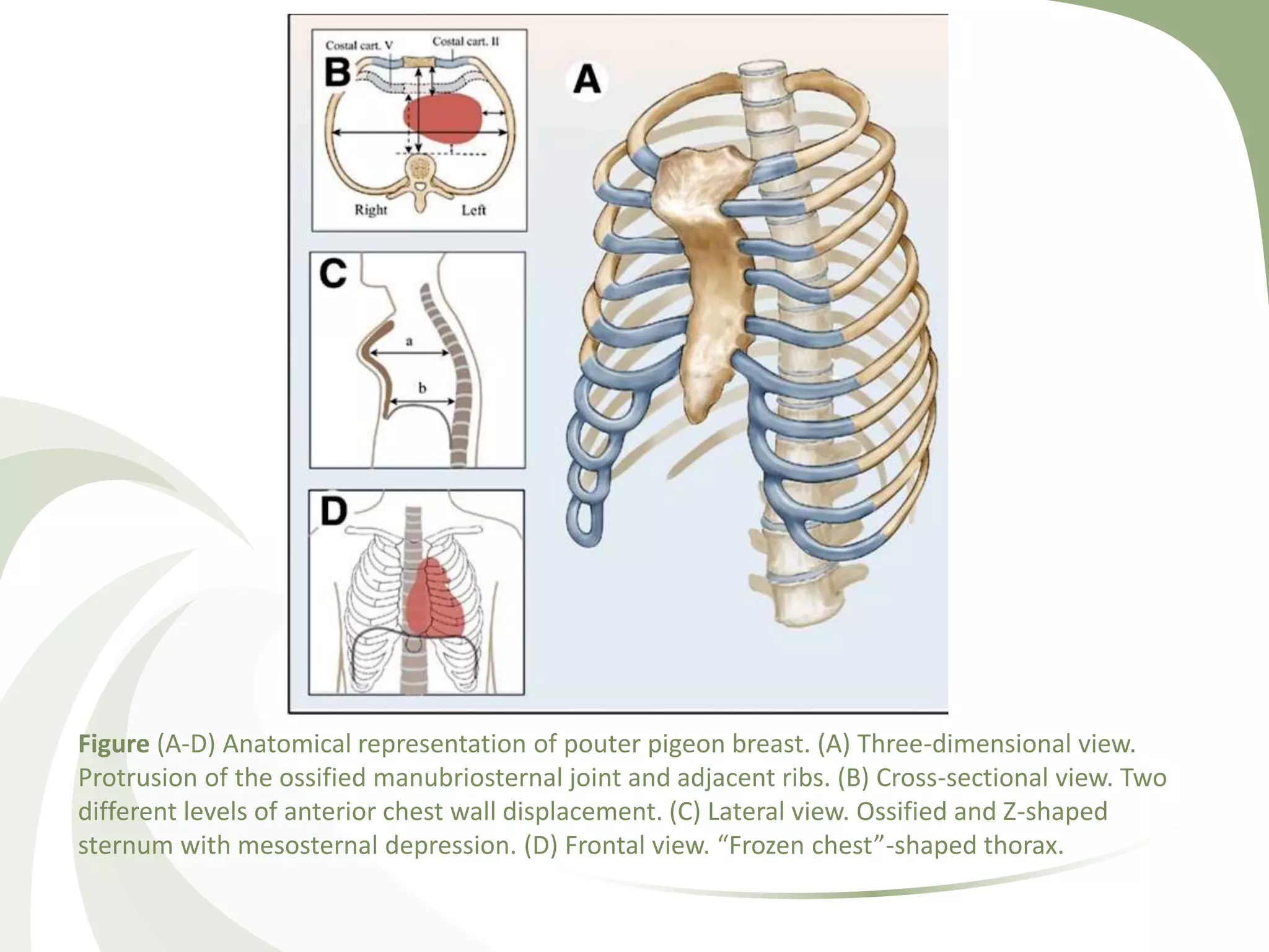 Congenital Chest Wall Abnormality | PPTX