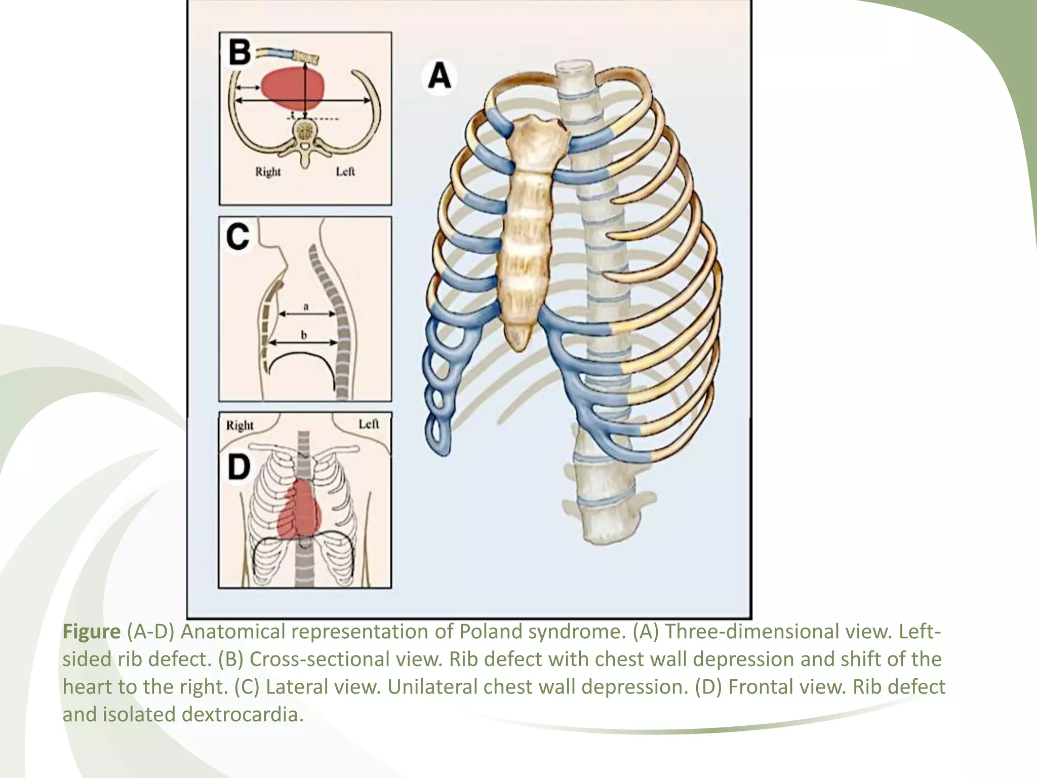Congenital Chest Wall Abnormality | PPTX