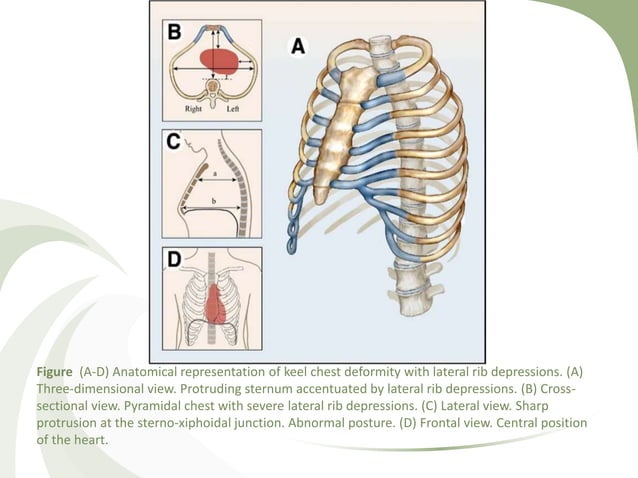 Congenital Chest Wall Abnormality | PPTX