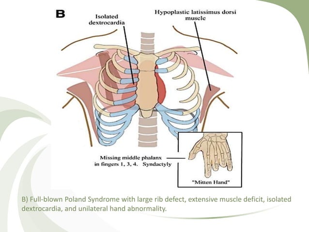Congenital Chest Wall Abnormality | PPTX