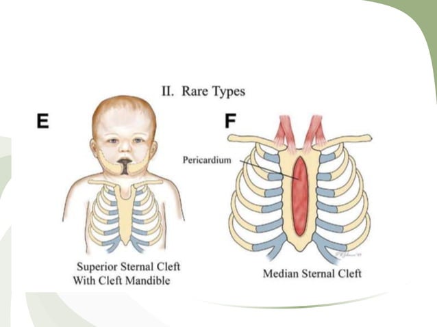 Congenital Chest Wall Abnormality | PPTX