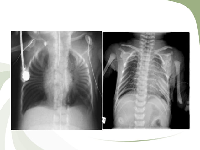Congenital Chest Wall Abnormality | PPTX