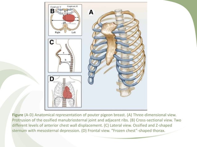 Congenital Chest Wall Abnormality