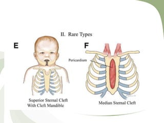 Congenital Chest Wall Abnormality | PPT