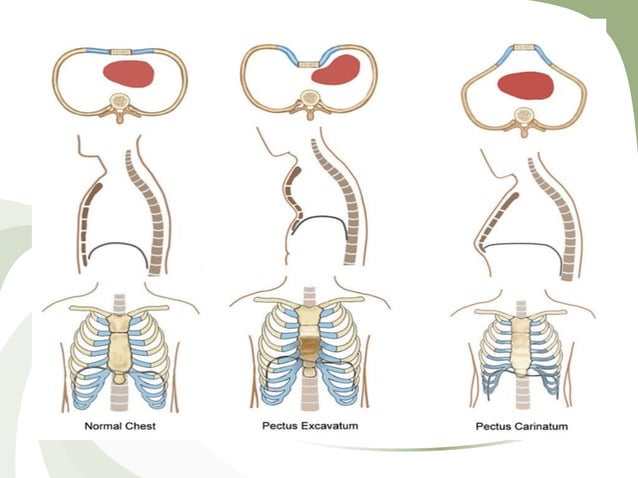 Congenital Chest Wall Abnormality