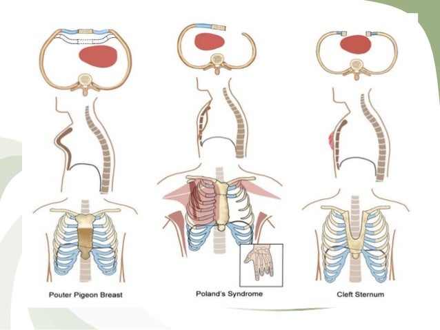 Congenital Chest Wall Abnormality
