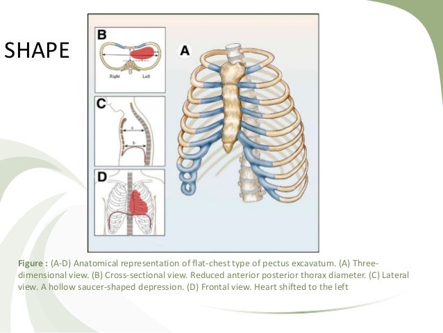 Congenital Chest Wall Abnormality